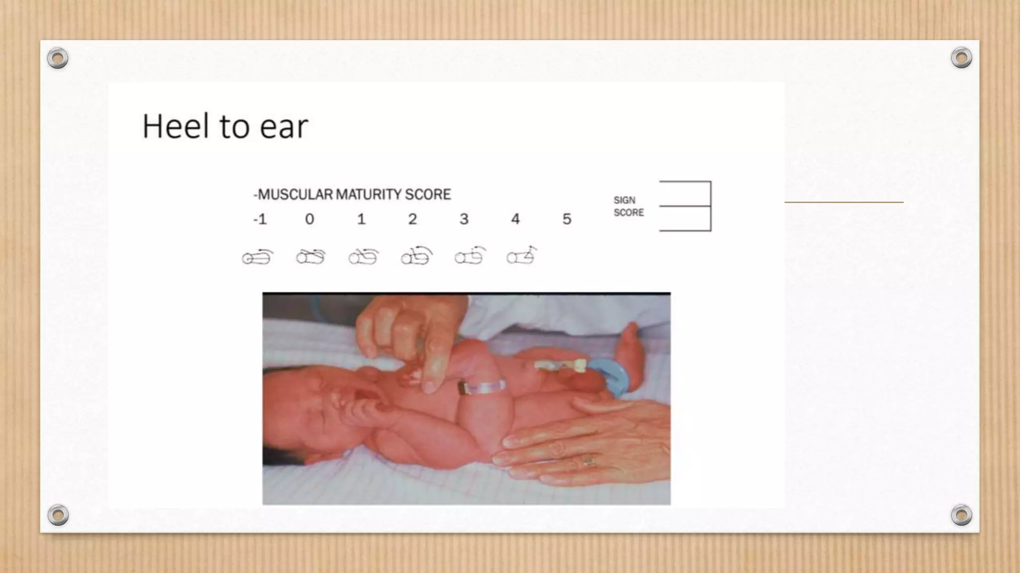 Pre maturity of newborn | PPT