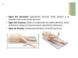 Apendicitis Pediatría | PPTX