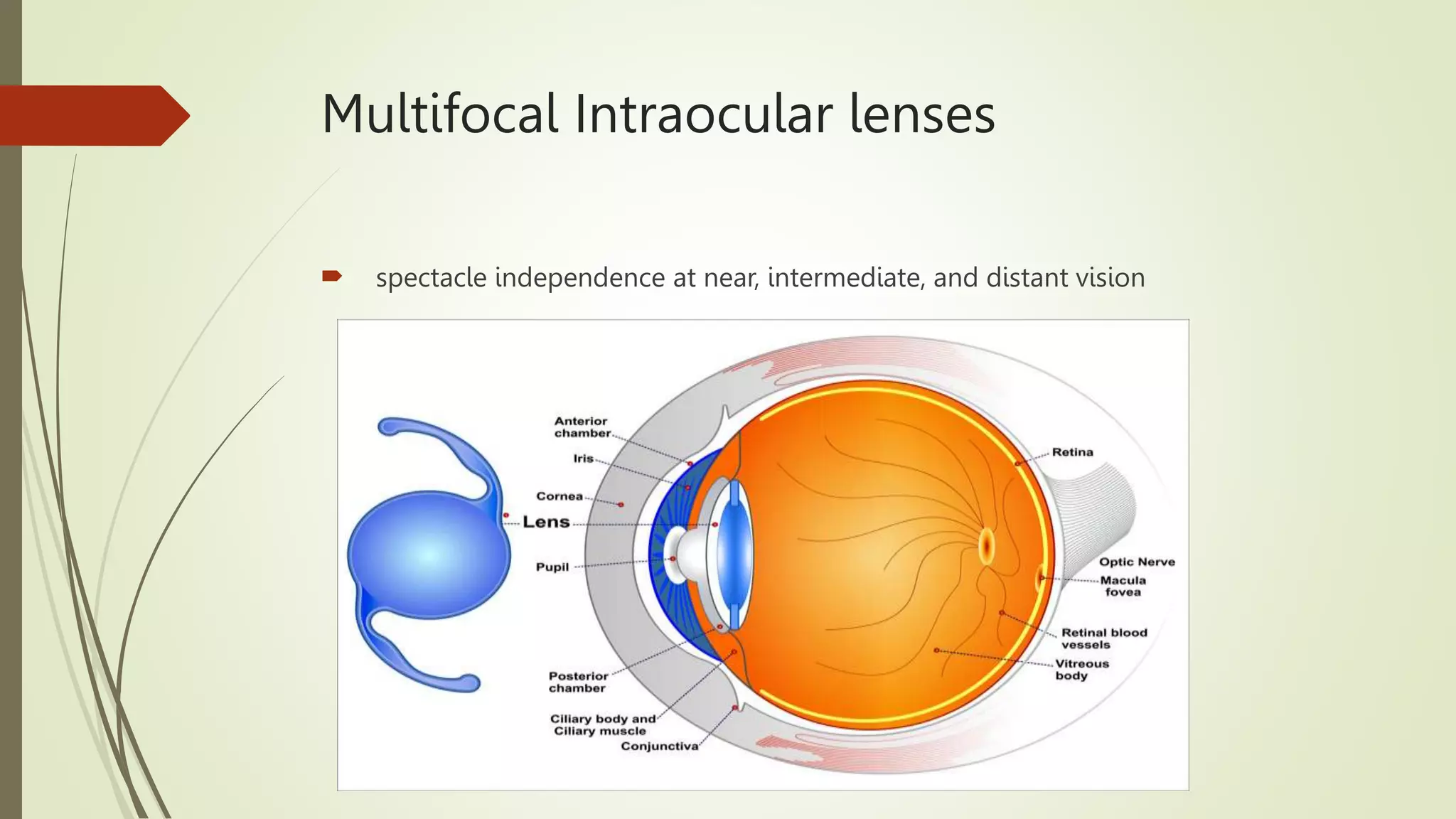 Premium intraocular lenses The past, present and-3.pptx