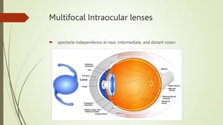Premium intraocular lenses The past, present and-3.pptx