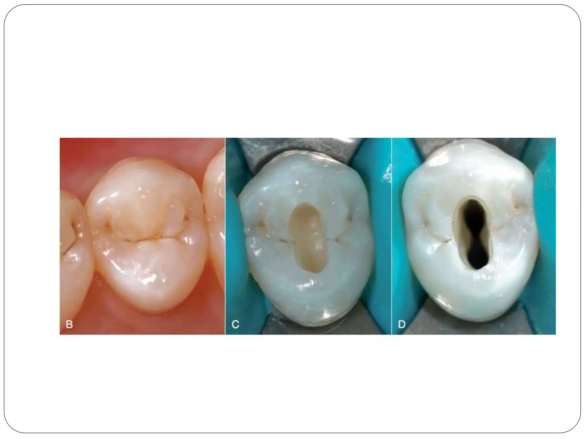 Anatomy of canines and premolars (ENDO) | PPSX