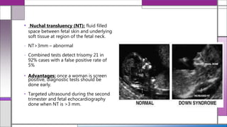 Prenatal Diagnosis | PPTX