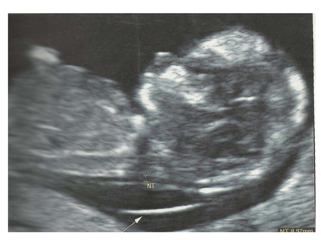 Prenatal diagnosis and fetal therapy | PPTX