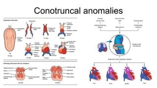 Prenatal diagnosis of congenital heart defects | PPTX