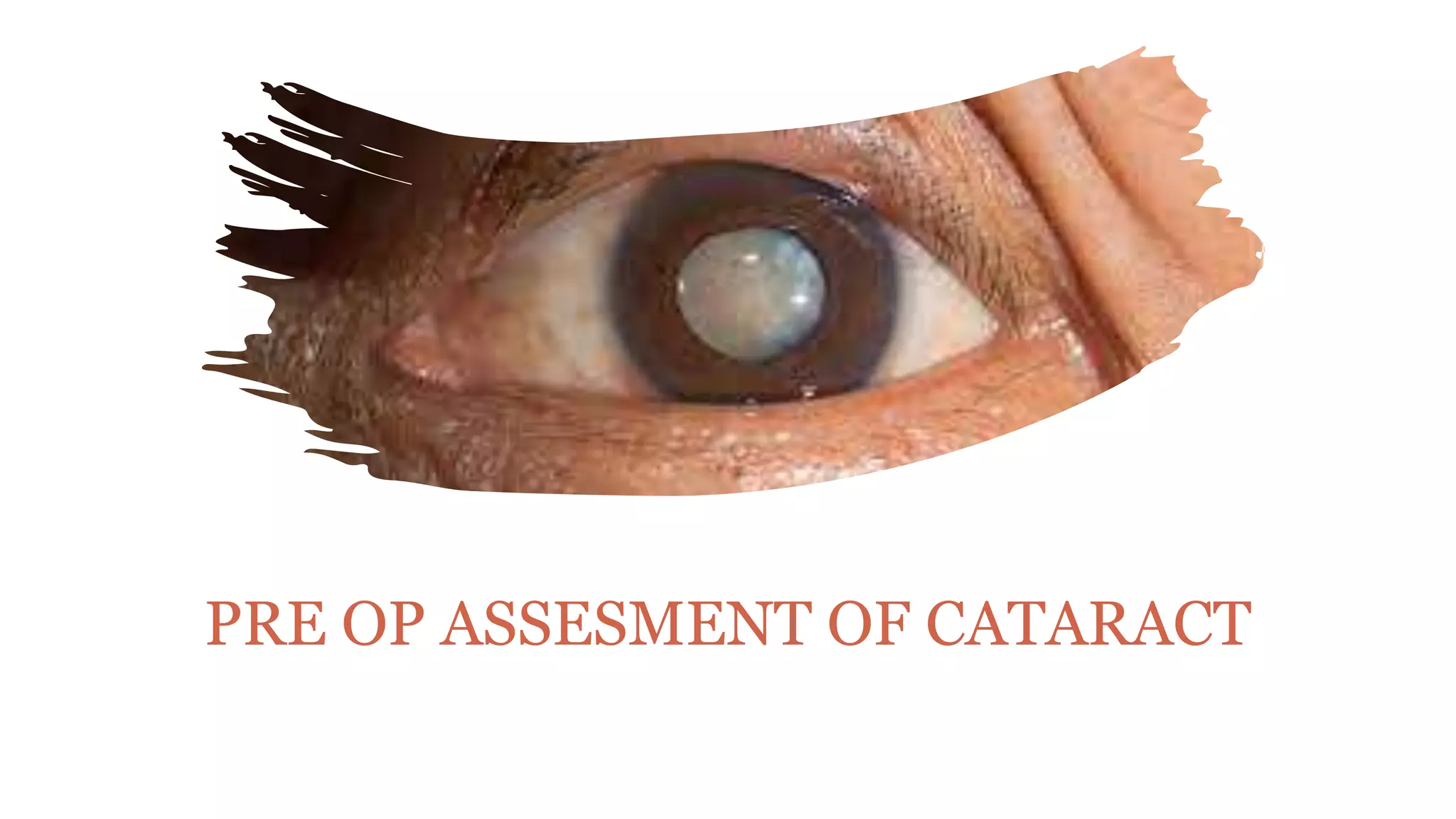 Pre-Op Assessment of Cataract | PPTX