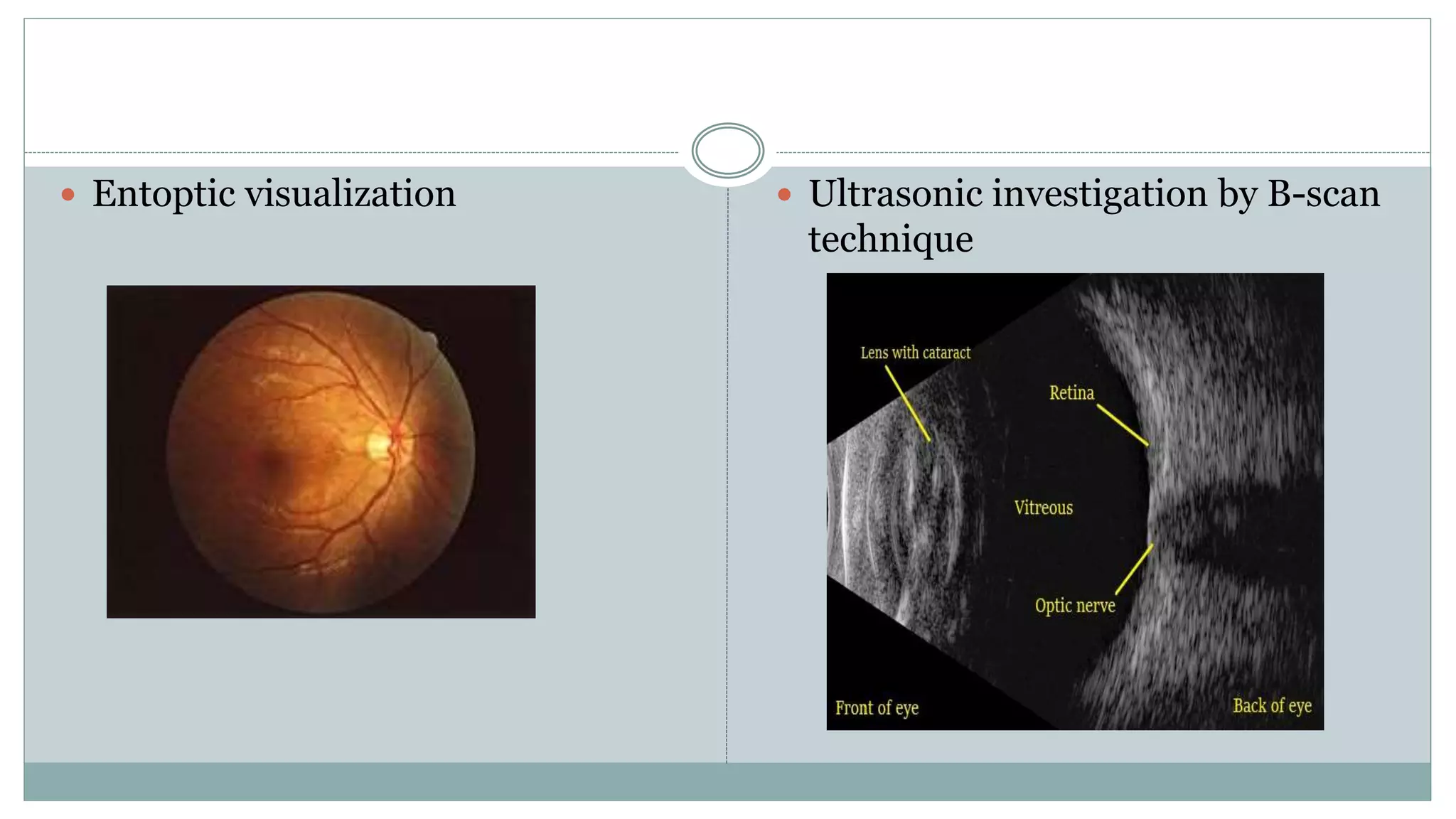 Pre-Op Assessment of Cataract | PPTX