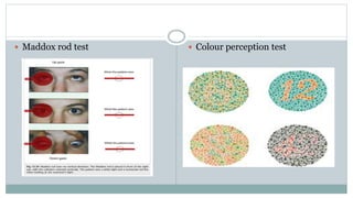 Pre-Op Assessment of Cataract | PPTX