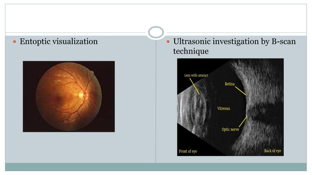 Pre-Op Assessment of Cataract | PPTX