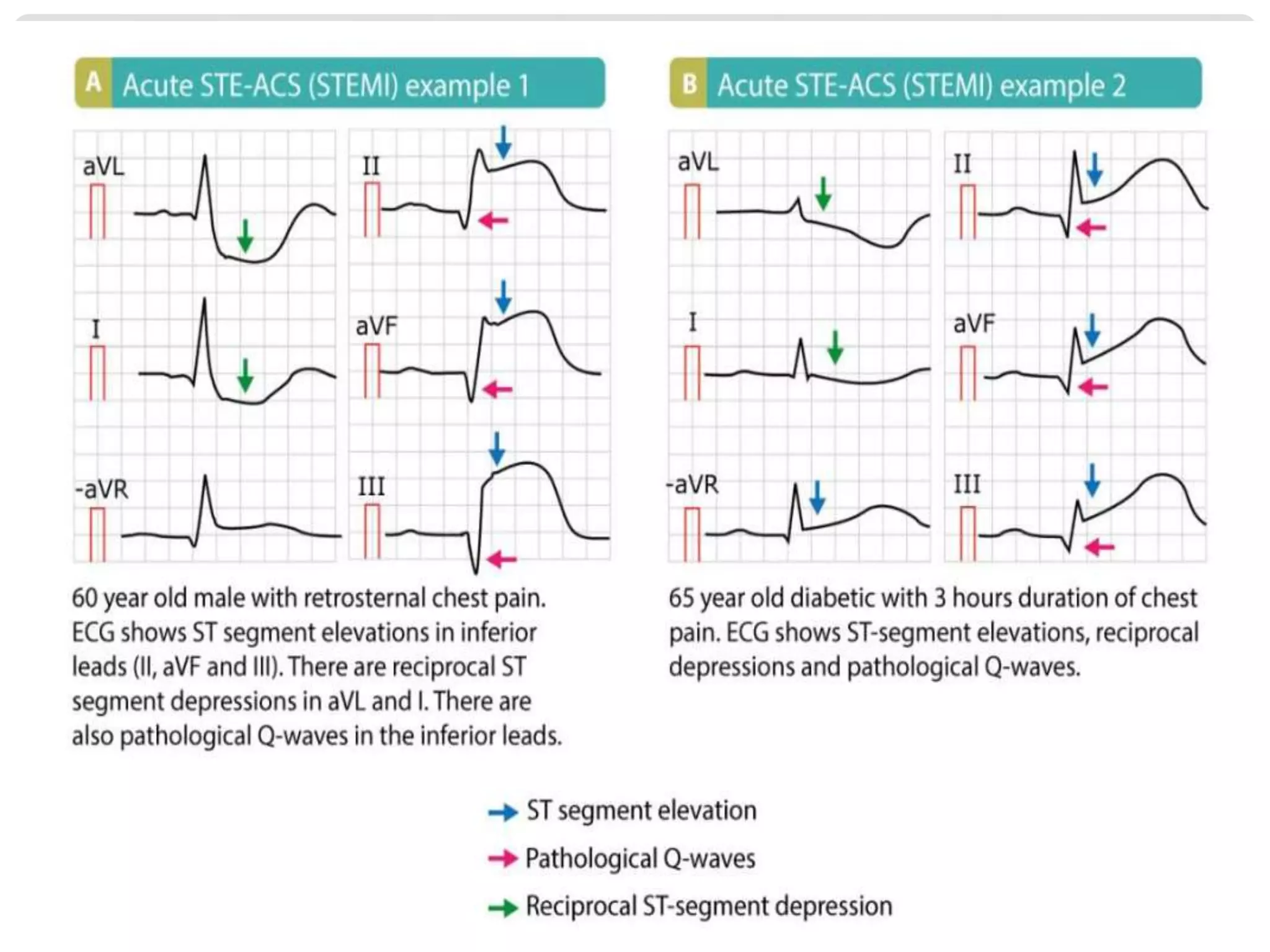 Perioperative EKG in Cardiothoracic Anesthesia | PPTX