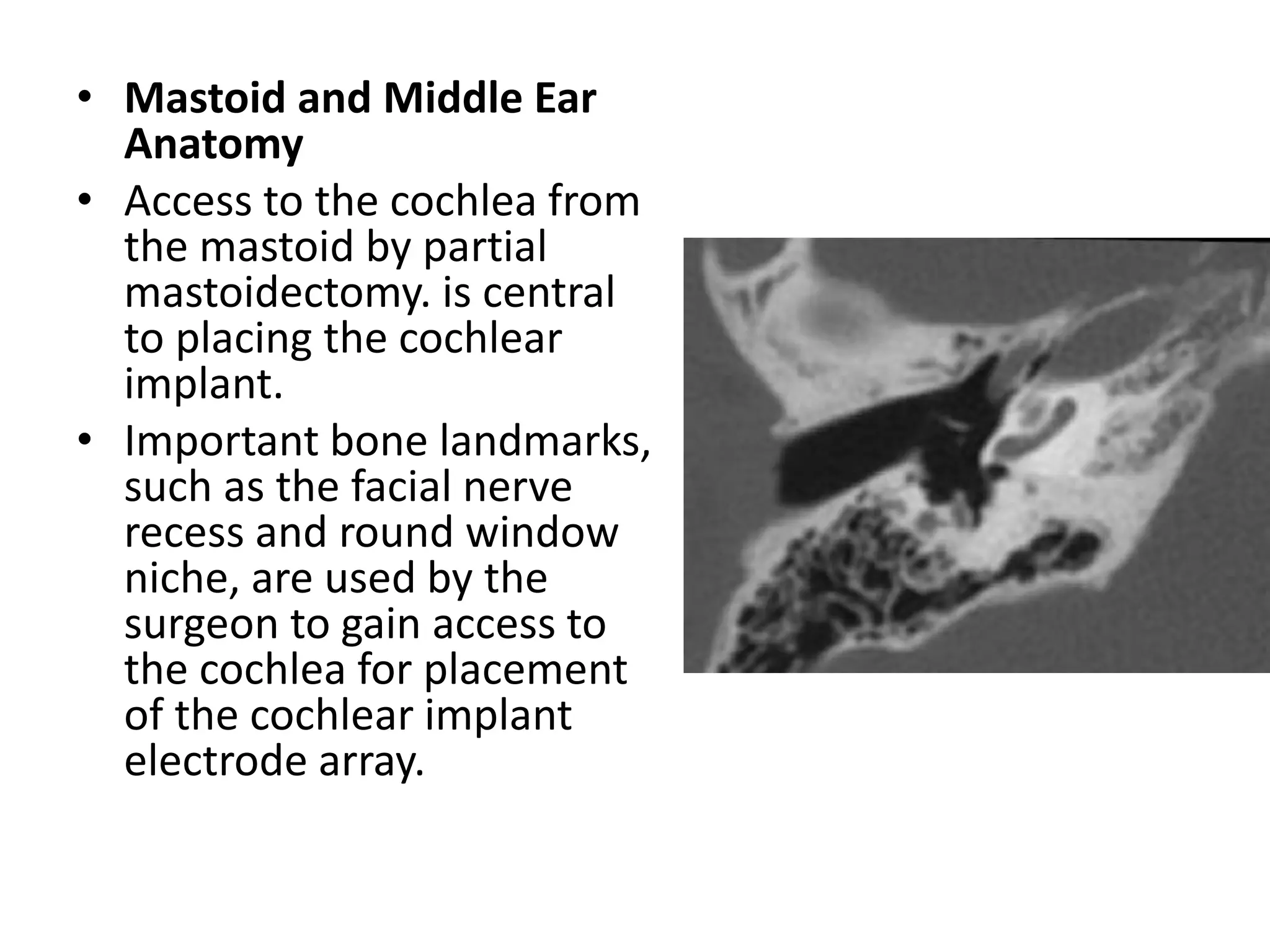 Preoperative Assesment In Cochlear Implantation Ppt