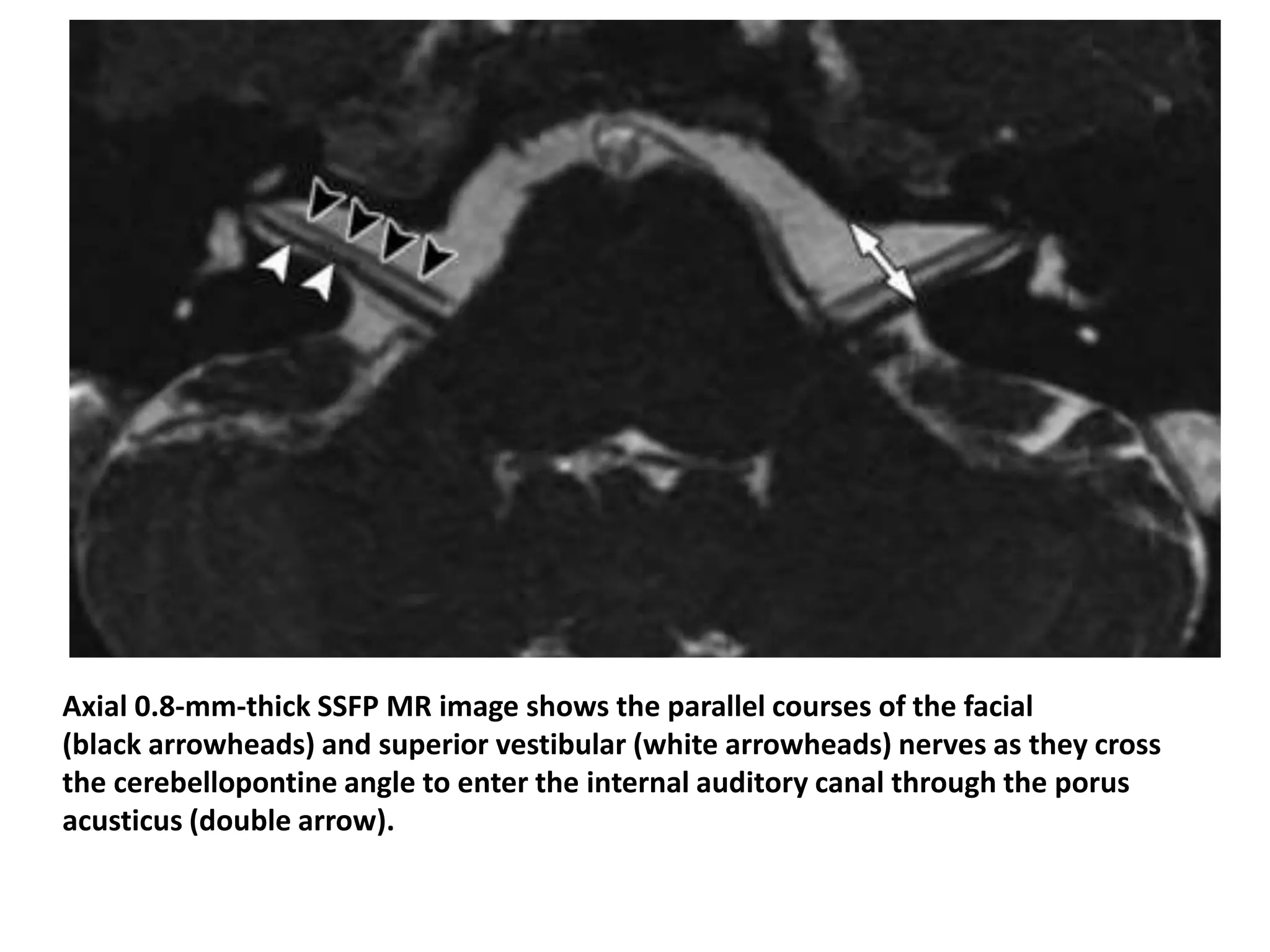 Preoperative assesment in cochlear implantation | PPTX