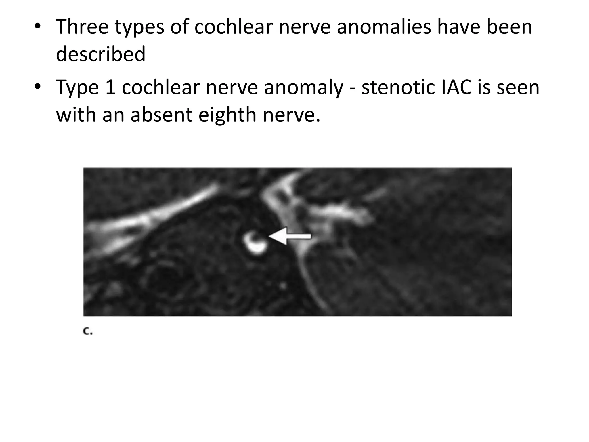 Preoperative assesment in cochlear implantation | PPTX