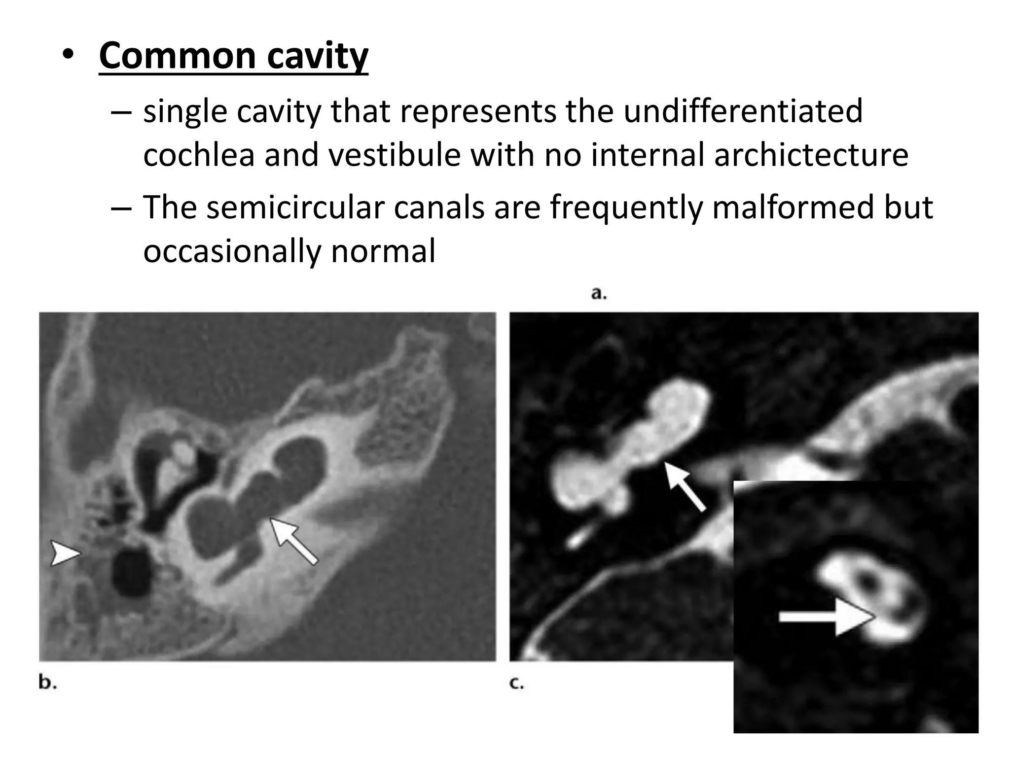Preoperative assesment in cochlear implantation | PPTX