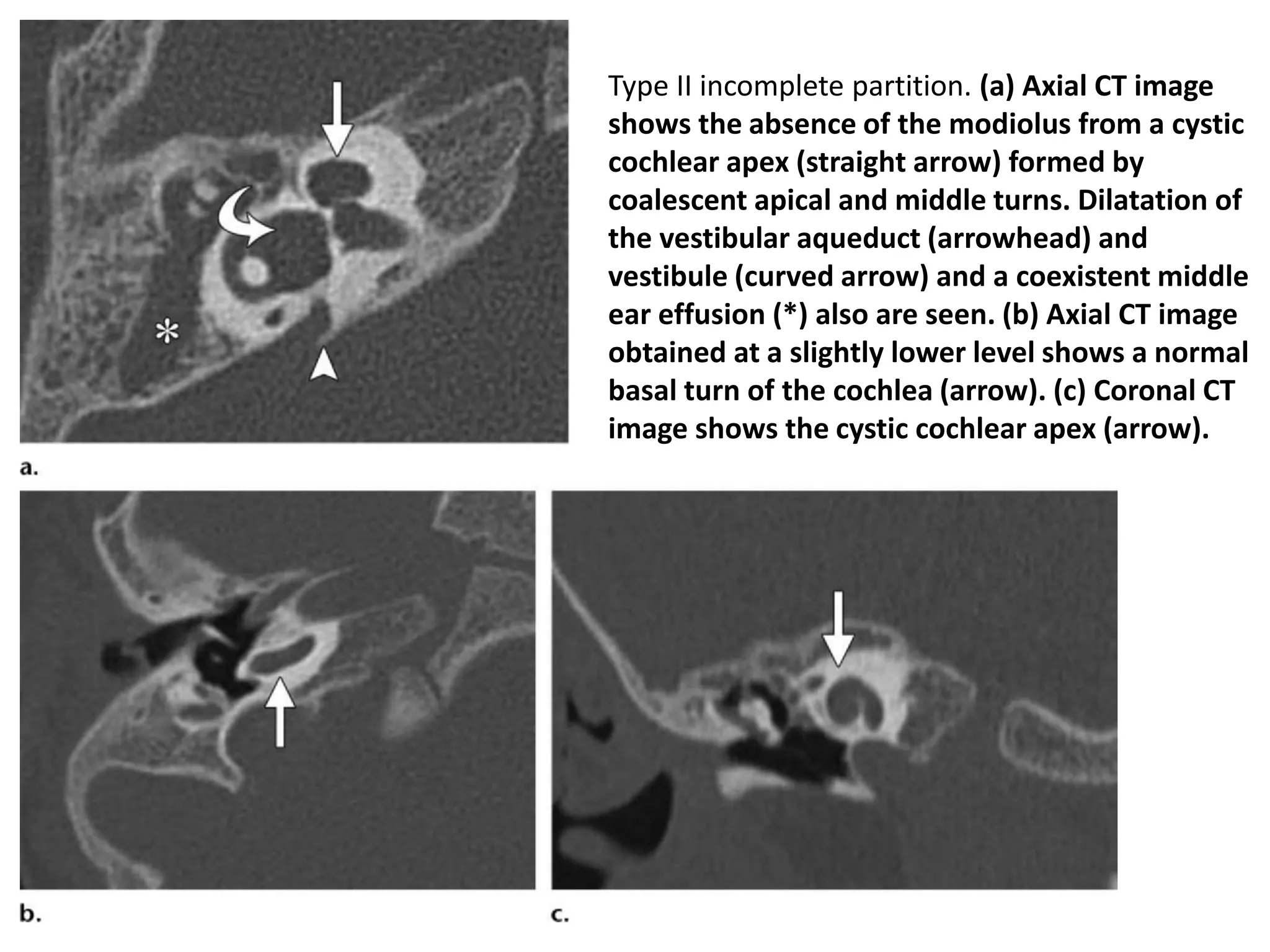 Preoperative assesment in cochlear implantation | PPTX