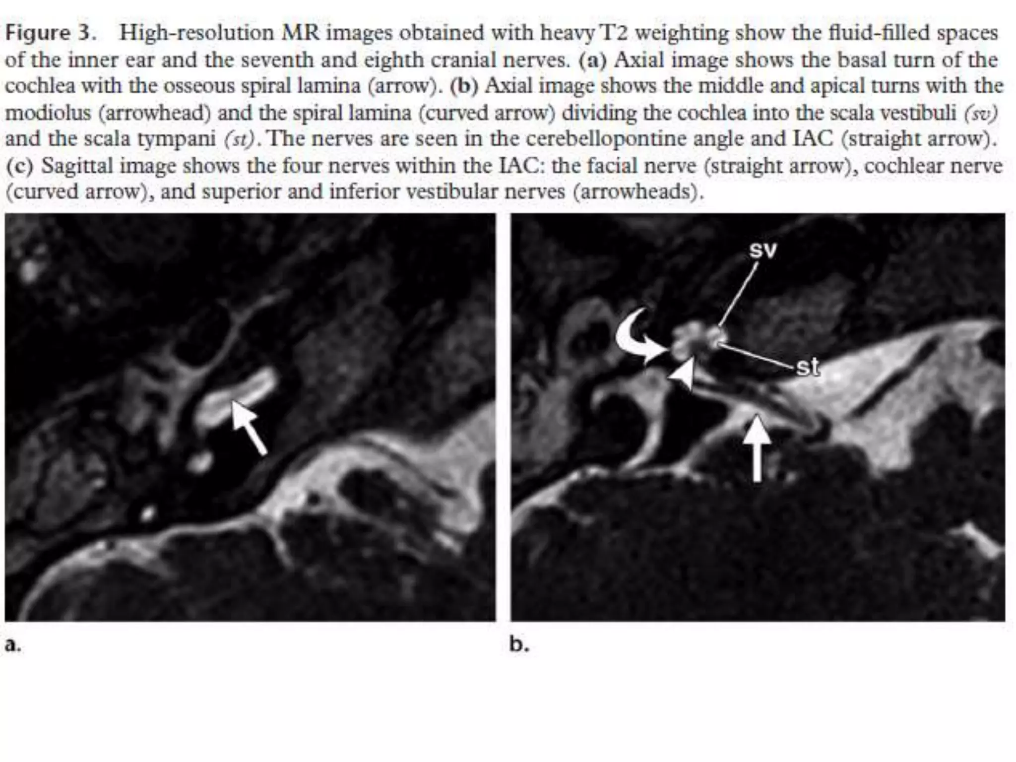 Preoperative assesment in cochlear implantation | PPTX