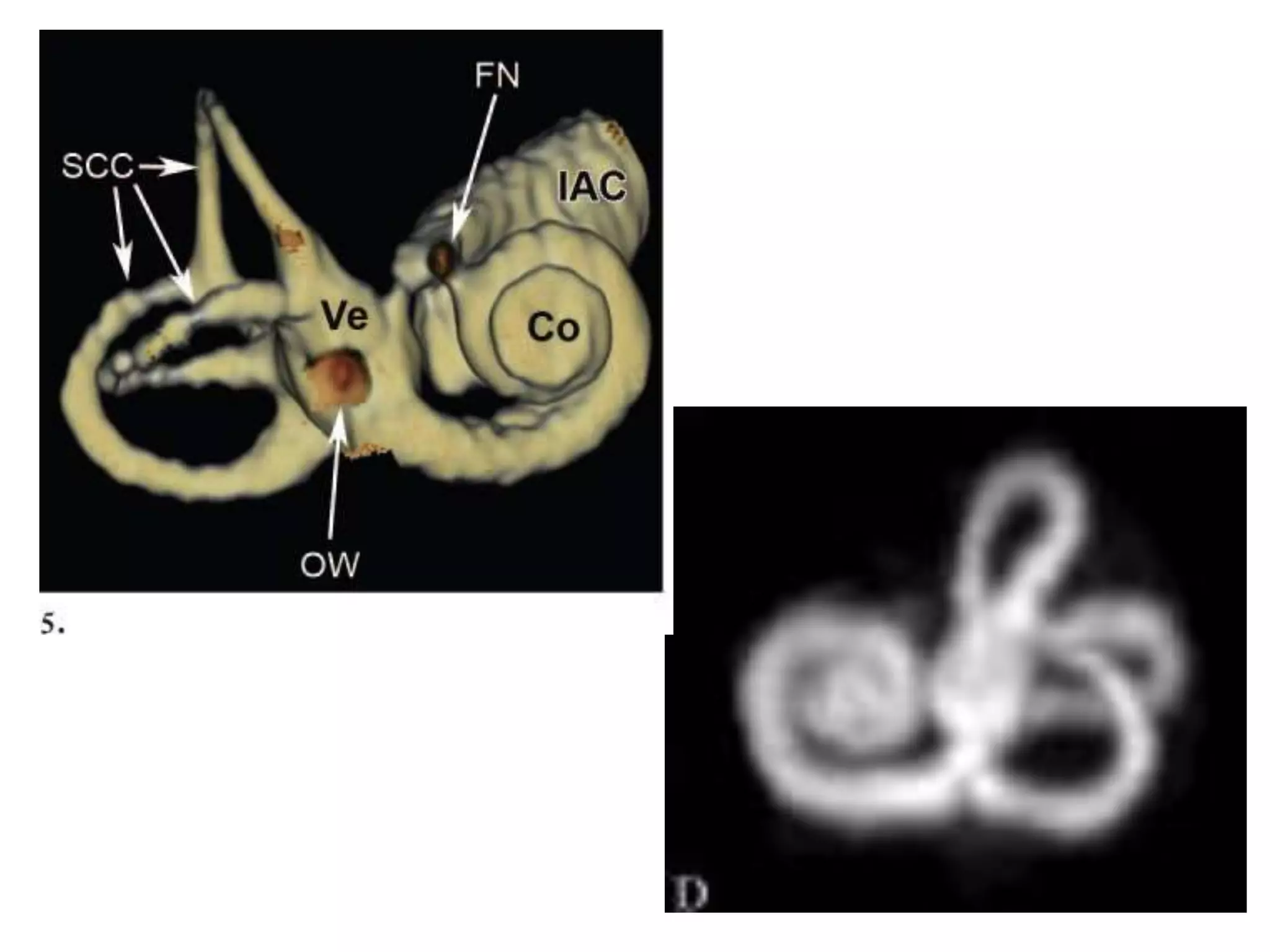 Preoperative assesment in cochlear implantation | PPTX