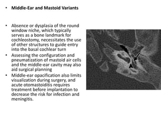 Preoperative assesment in cochlear implantation | PPTX