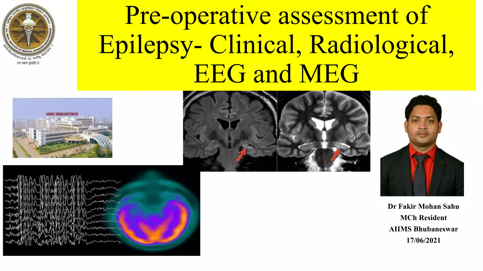 Preoperative assessment of epilepsy clinical & radiological, eeg, meg ...