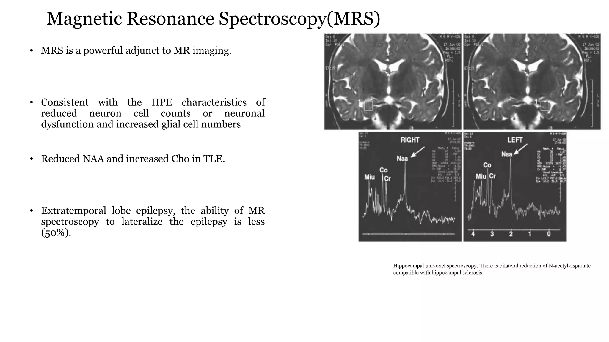 Preoperative assessment of epilepsy clinical & radiological, eeg, meg ...