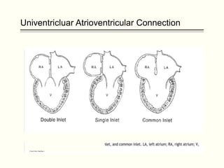 Pre operative evaluation of Single ventricle Disease | PPT