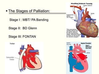 Pre operative evaluation of Single ventricle Disease | PPT