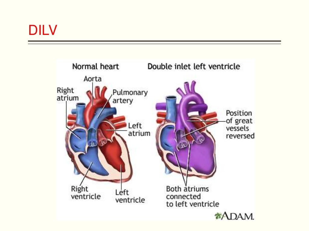 Pre operative evaluation of Single ventricle Disease