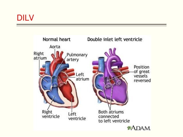 Pre operative evaluation of Single ventricle Disease