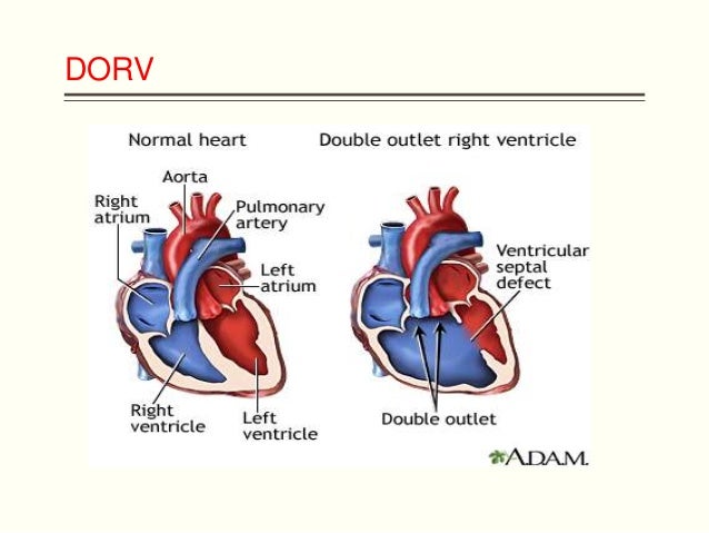 Pre operative evaluation of Single ventricle Disease