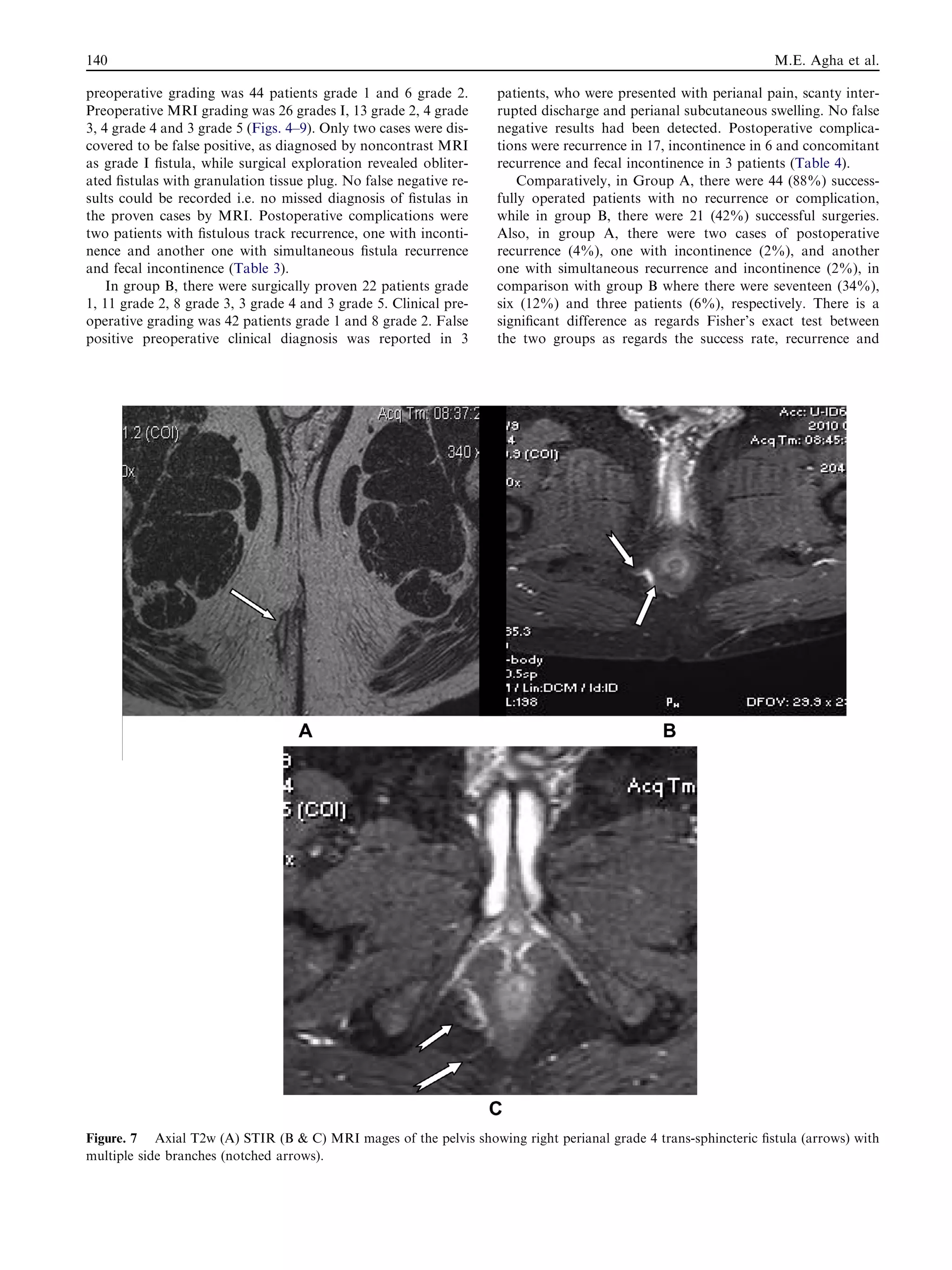 Preoperative mri of perianal fistula | PDF