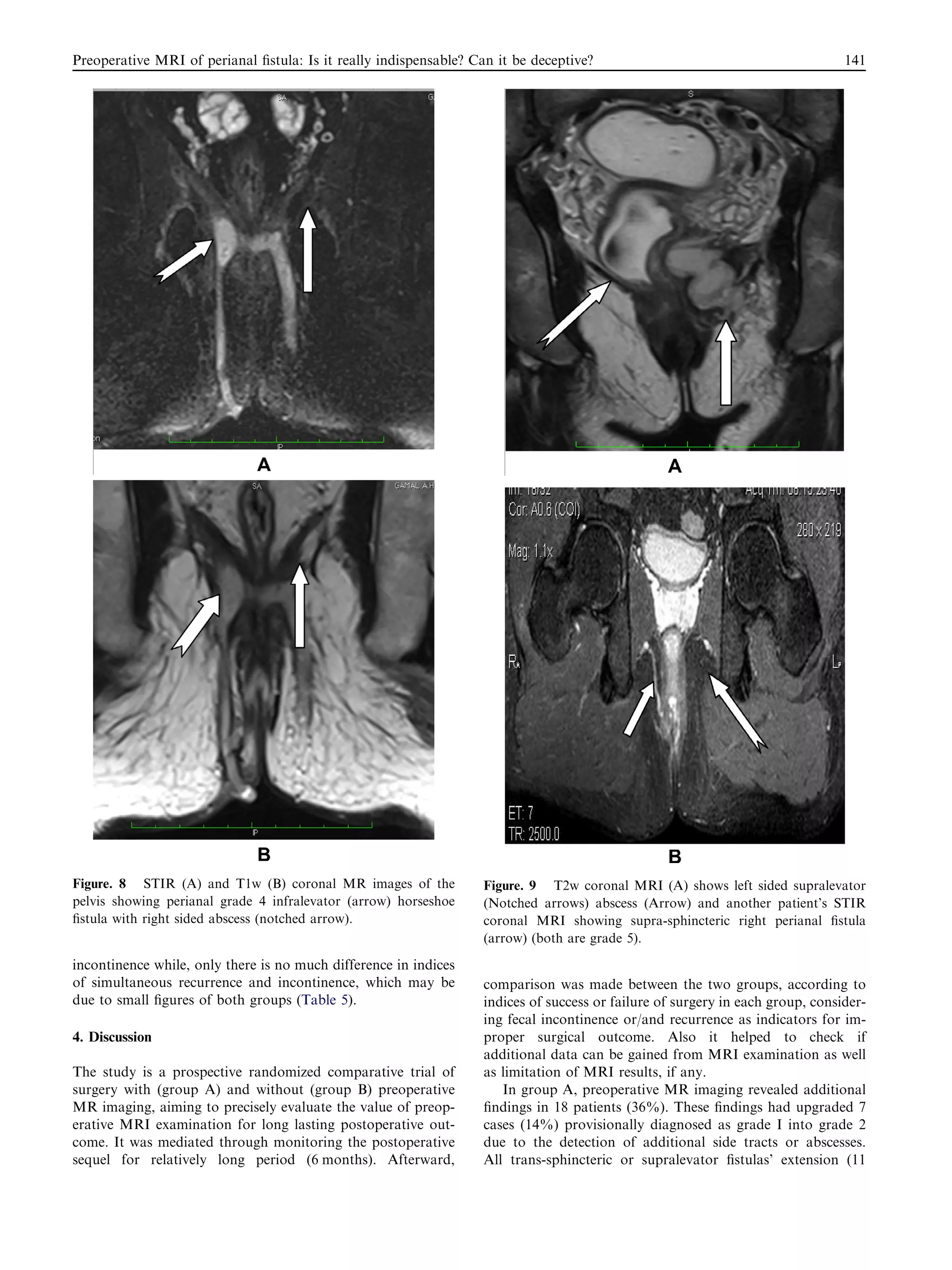 Preoperative mri of perianal fistula | PDF