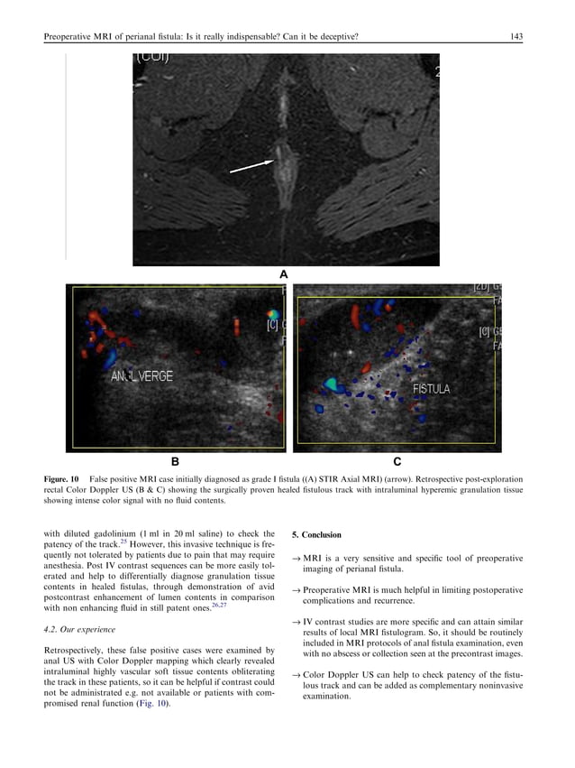 Preoperative mri of perianal fistula | PDF
