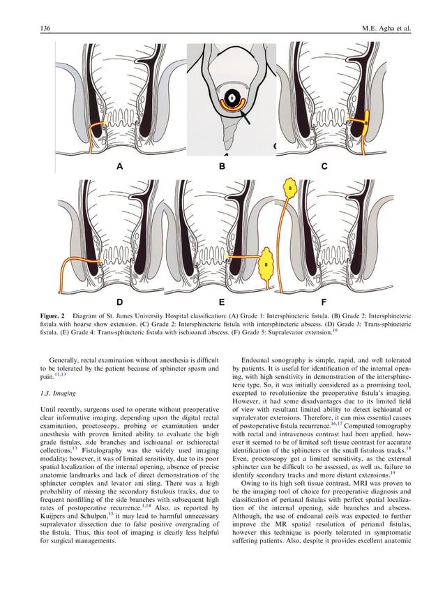 Preoperative mri of perianal fistula | PDF