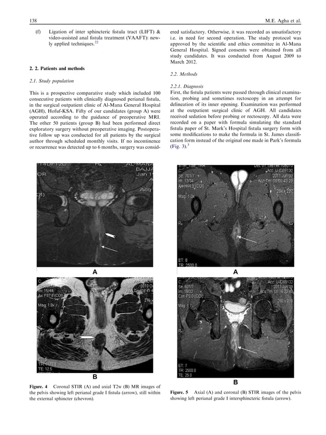 Preoperative mri of perianal fistula | PDF