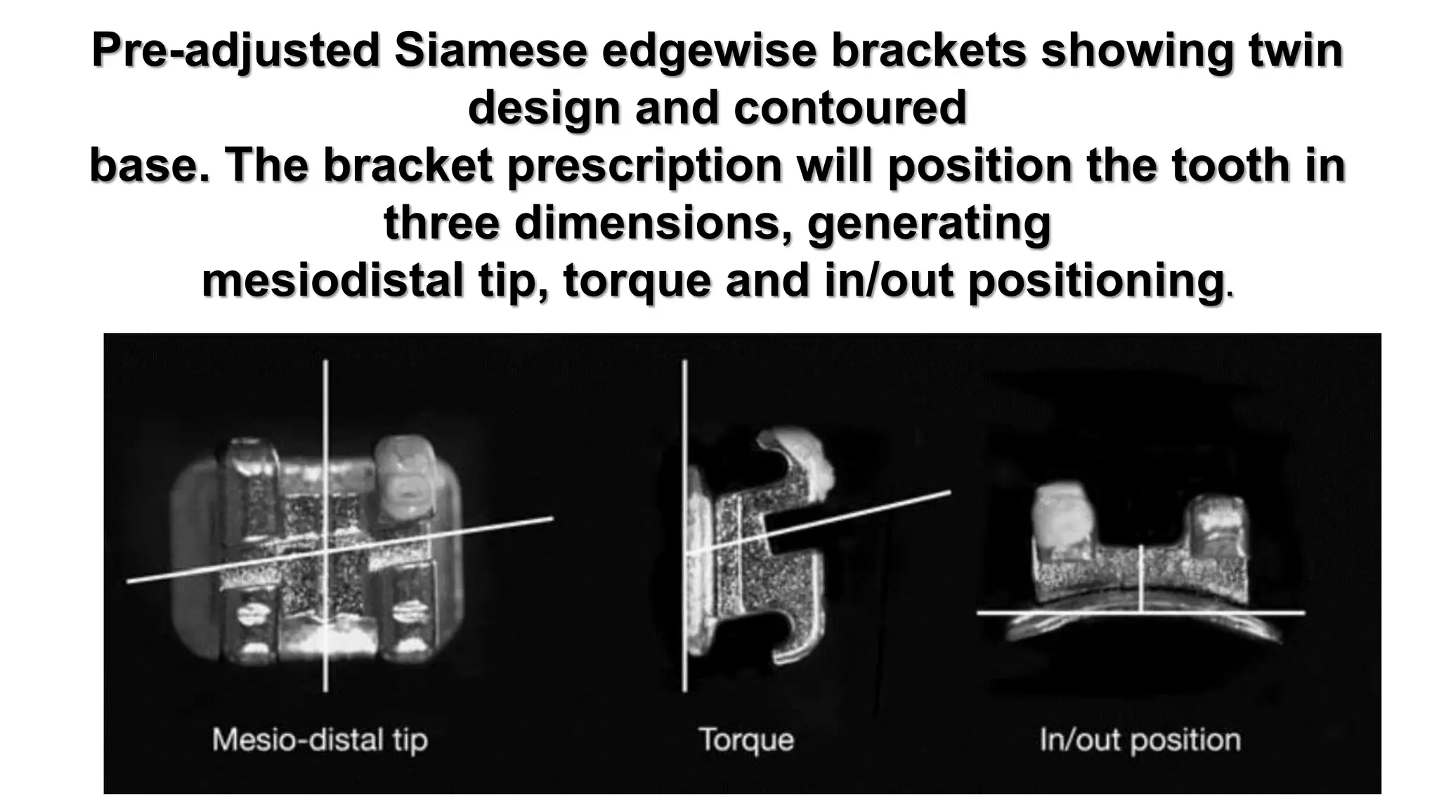 Preoperative orthodontics for orthognathic surgery | PPTX