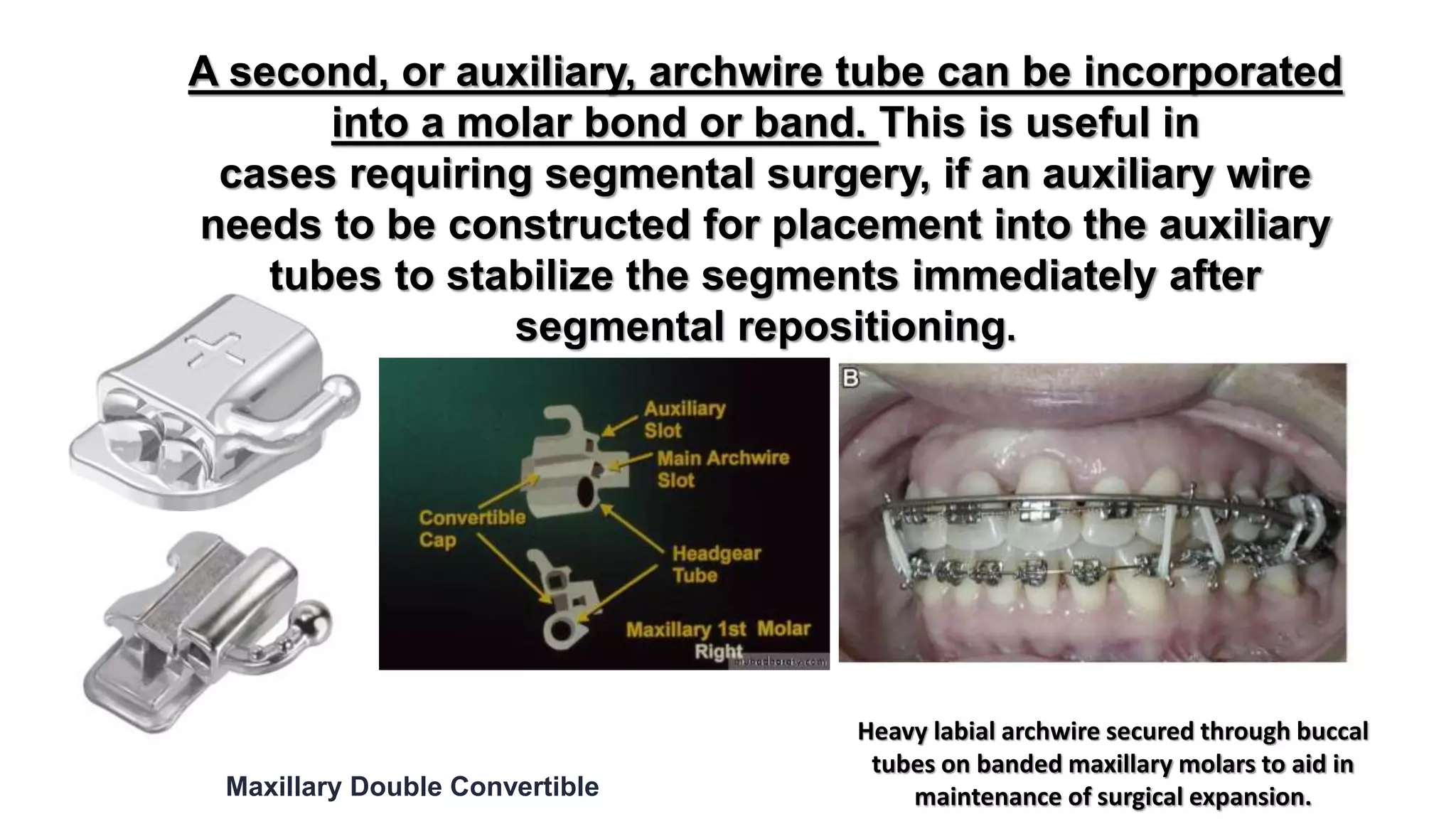 Preoperative orthodontics for orthognathic surgery | PPTX