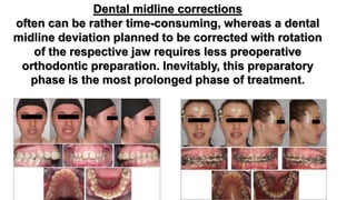 Preoperative orthodontics for orthognathic surgery | PPTX