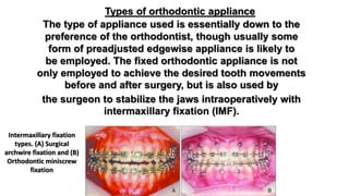 Preoperative orthodontics for orthognathic surgery | PPTX