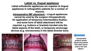 Preoperative orthodontics for orthognathic surgery | PPTX