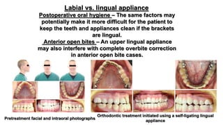 Preoperative orthodontics for orthognathic surgery | PPTX