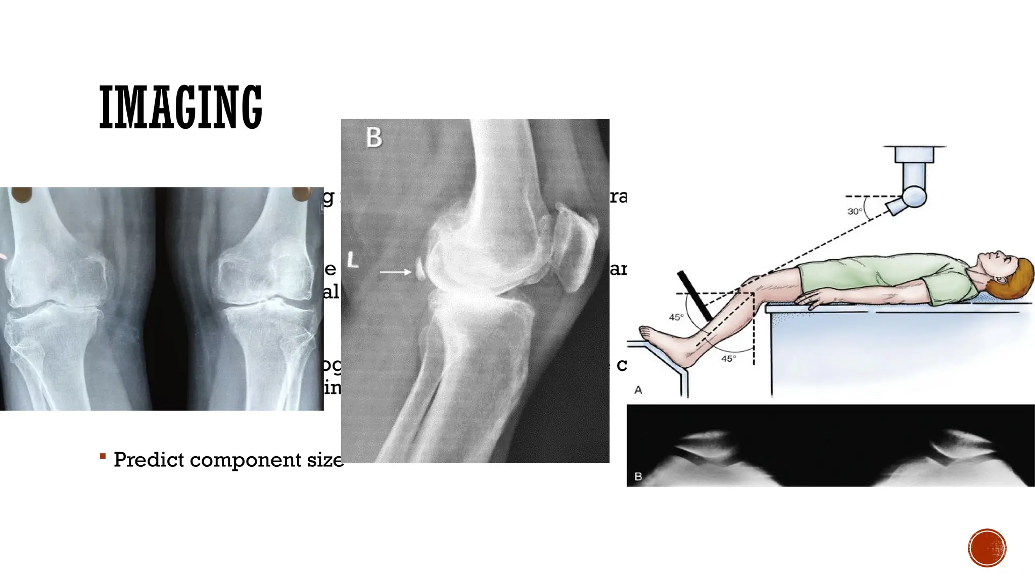 Preoperative Planning TKR and Rehabilitation.pptx