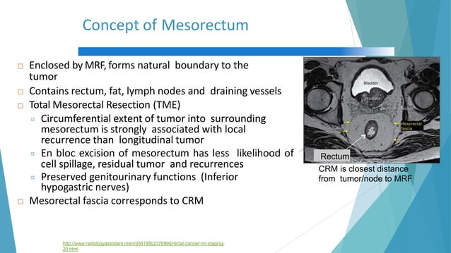 Management of Rectal Carcinoma | PPTX