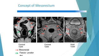 Management of Rectal Carcinoma | PPTX