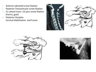 preop planning for odontoid fracture.pptx