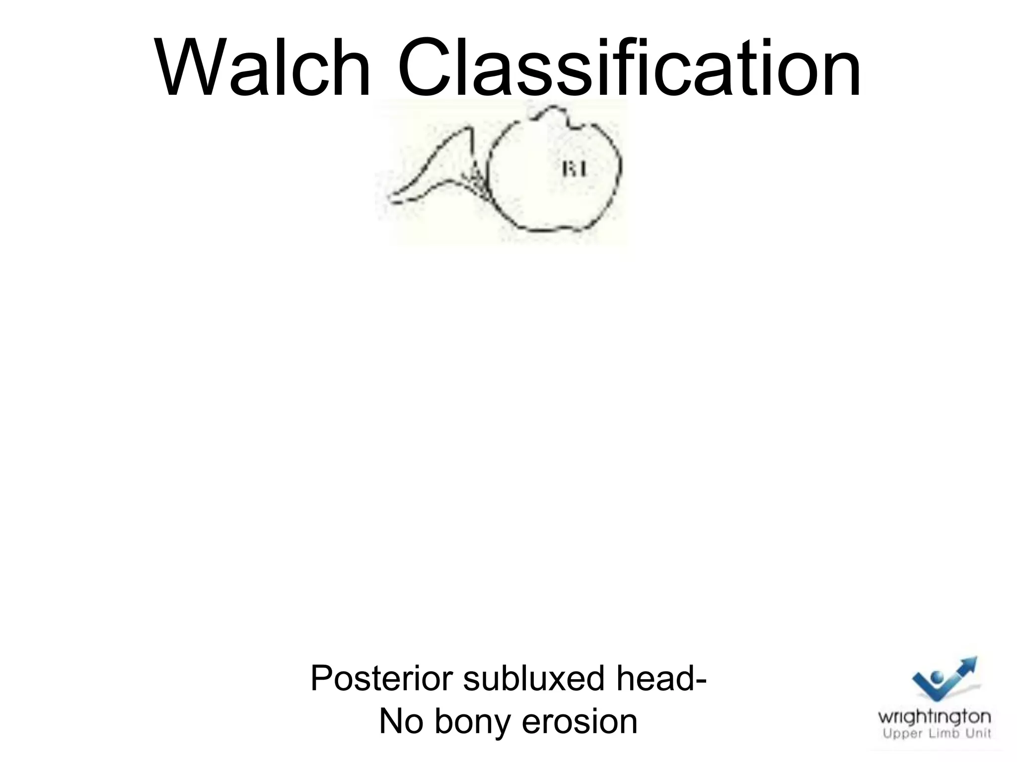 Pre op planning for shoulder arthroplasty | PPTX