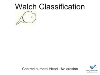 Pre op planning for shoulder arthroplasty | PPTX