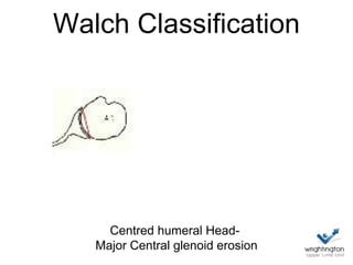 Pre op planning for shoulder arthroplasty | PPTX