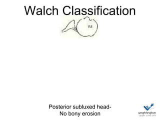 Pre op planning for shoulder arthroplasty | PPTX