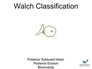 Pre op planning for shoulder arthroplasty | PPTX