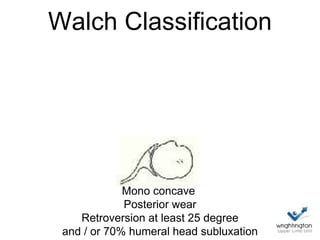 Pre op planning for shoulder arthroplasty | PPTX