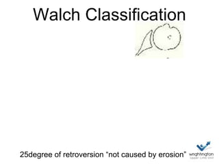 Pre op planning for shoulder arthroplasty | PPTX